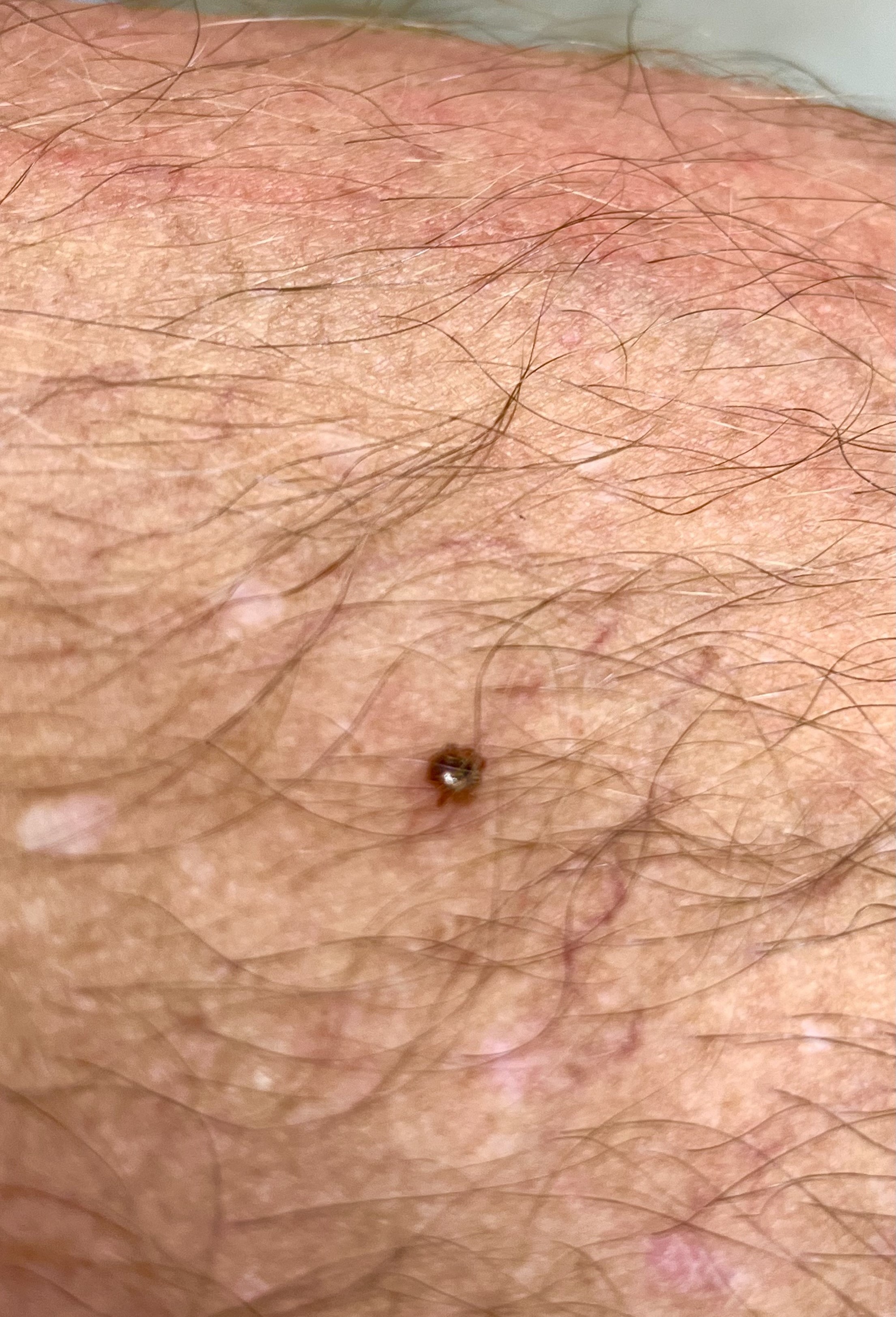 Don’t Let Ticks Ruin Your Time Hiking and Backpacking in Florida ...